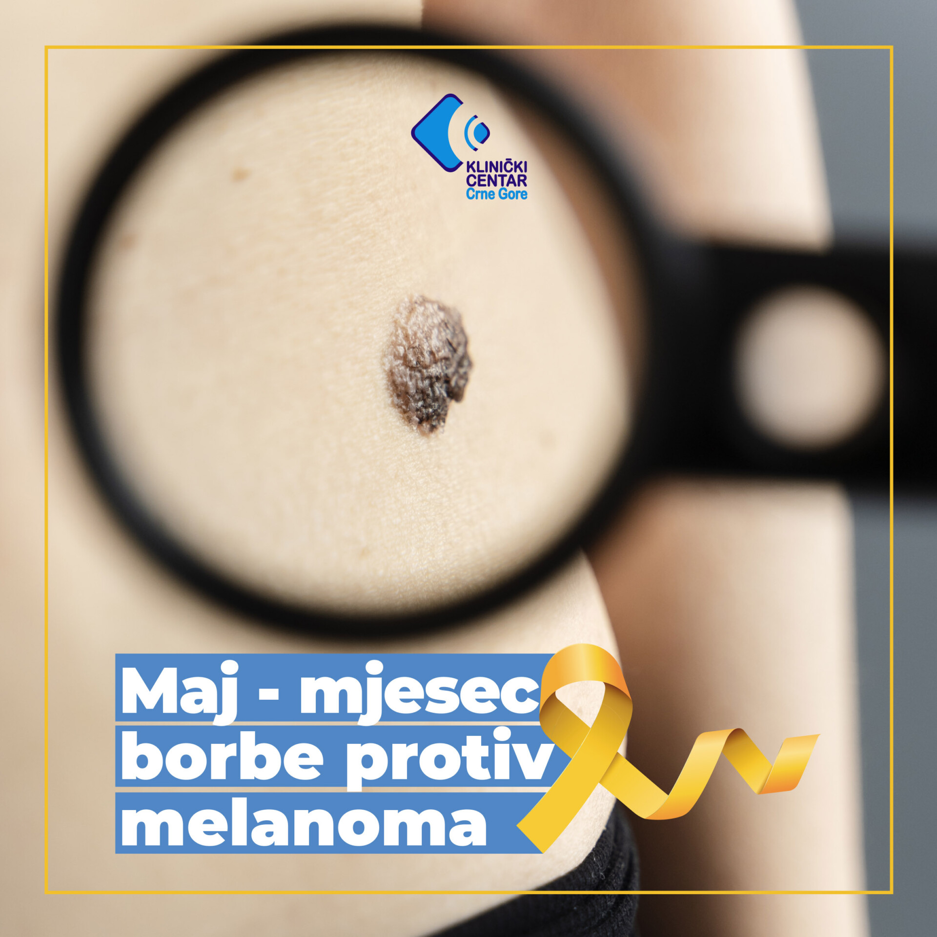 Maj – mjesec borbe protiv melanoma - CdM